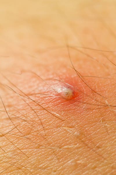 Pimple Extreme Macro stock image. Image of hair, bump - 23621239