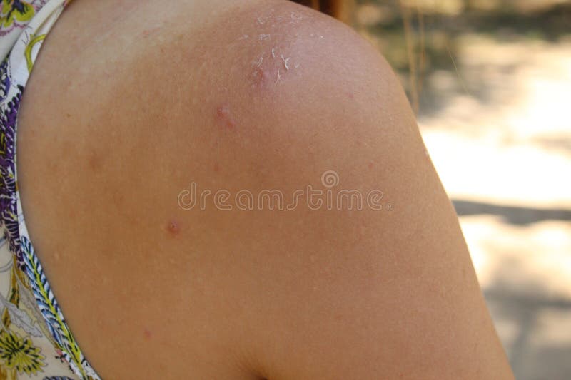Pimple on the Forearm. Skin Problems on the Back and Arms Stock Image ...