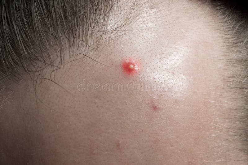 Pimple on the Forehead Close-up Stock Photo - Image of close, bacteria ...