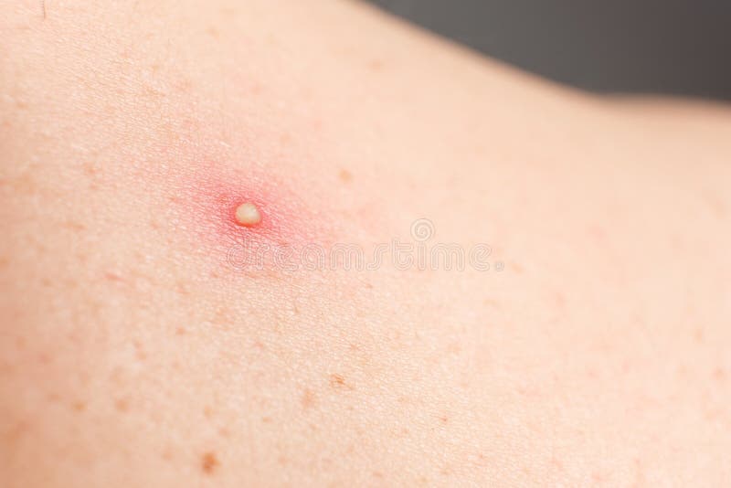 Pimple on the Human Body, Skin Problems. Stock Image - Image of ...