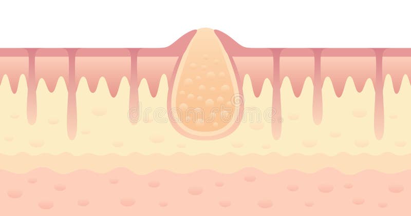 Pimple Stock Illustrations – 8,310 Pimple Stock Illustrations, Vectors ...