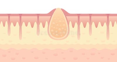 Closeup Acne Pimple Stock Illustrations – 442 Closeup Acne Pimple Stock ...