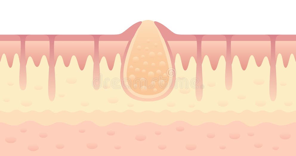 Closeup Acne Pimple Stock Illustrations – 442 Closeup Acne Pimple Stock ...