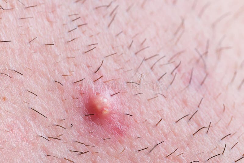 Pimple and Stubble stock photo. Image of care, skin, cosmetic - 55125572