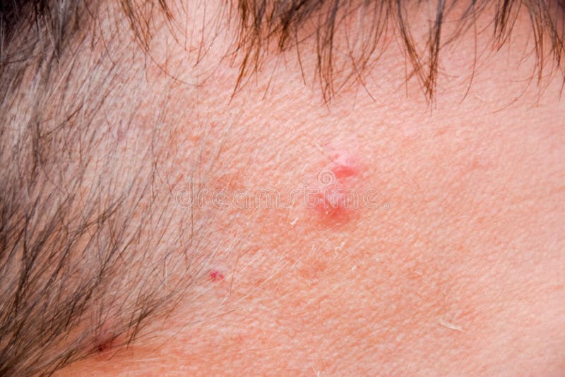 Pimples on the Forehead of Man. Acne on the Forehead Stock Photo ...