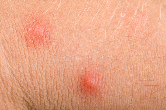 Pimples on skin stock photo. Image of sting, allergy, illness - 6823860