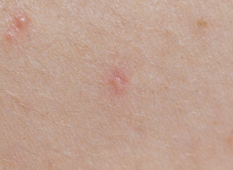 Pimples on the skin. close stock photo. Image of eruption - 94806626