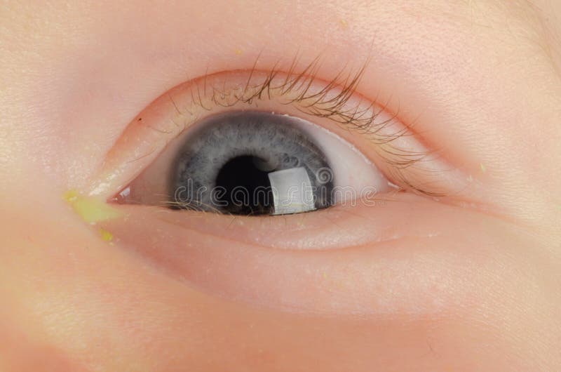 Pink eye (Conjunctivitis) stock photo. Image of hair - 34995420