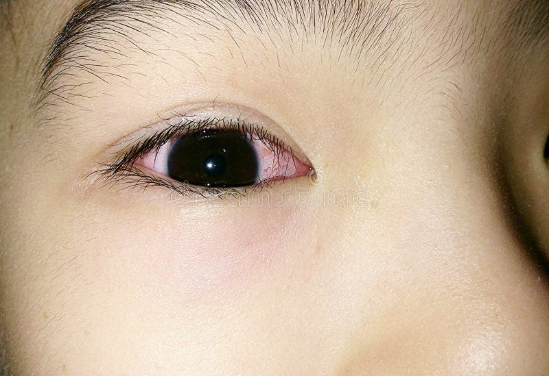 Pink eye stock image. Image of pink, right, undefined - 43035363
