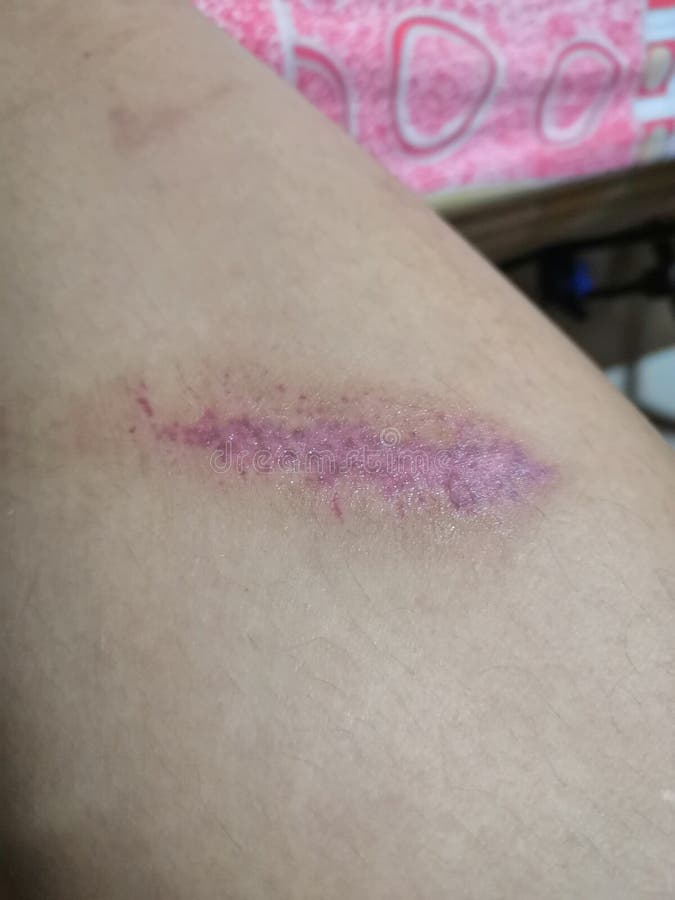 Pink skin scar stock photo. Image of organ, hand, violet - 194664122