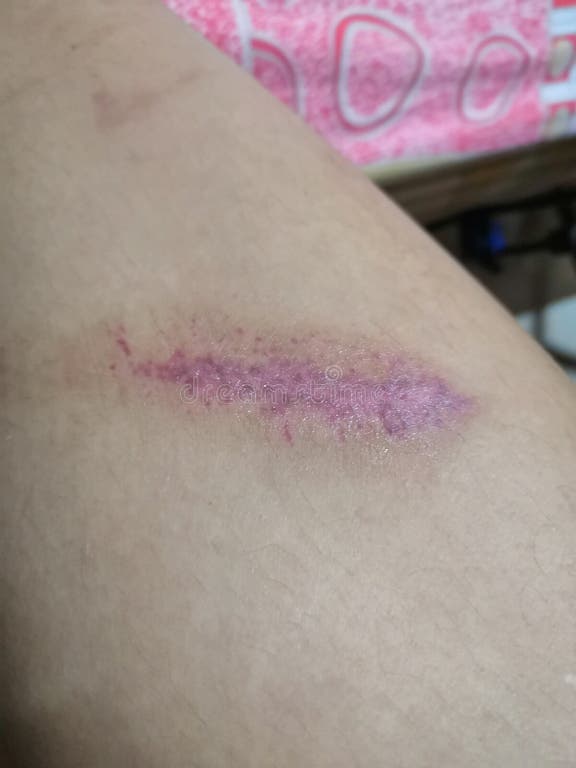 Pink skin scar stock photo. Image of organ, hand, violet - 194664122