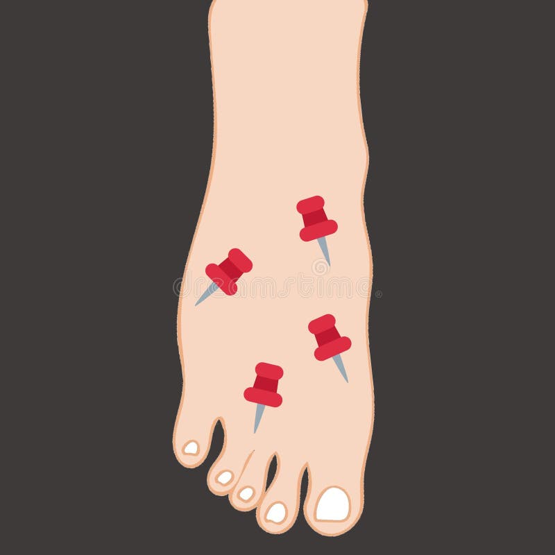 Pins and Needles Symptoms on Leg Disease - 1 Stock Illustration ...