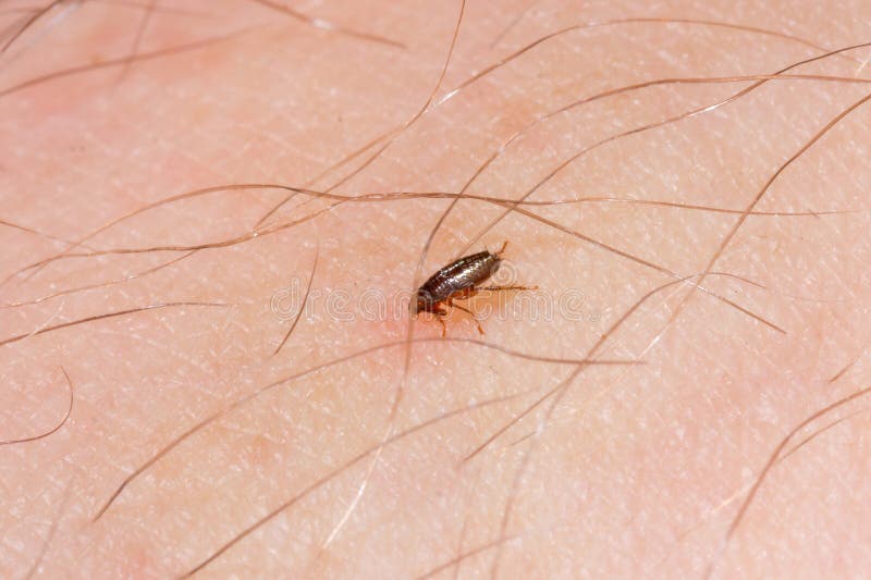 Piqûres De Puce Sur Un Humain Photo stock - Image du canis, cheveu ...
