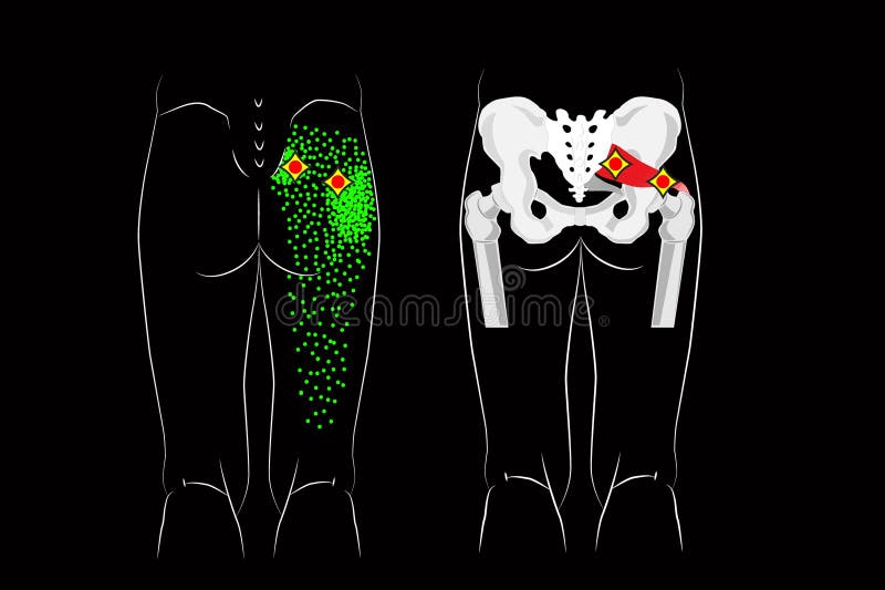 Piriformis Trigger Points Can Cause Buttocks Pain and Pain Down To the ...