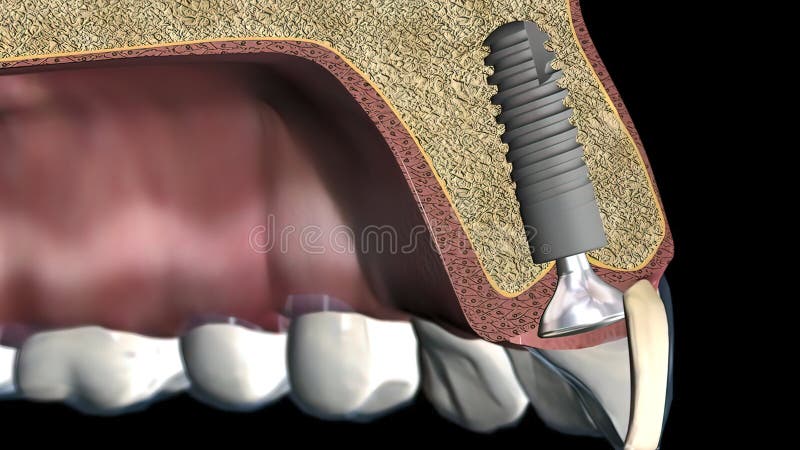 Placement and Alignment of the Implant Stock Illustration ...