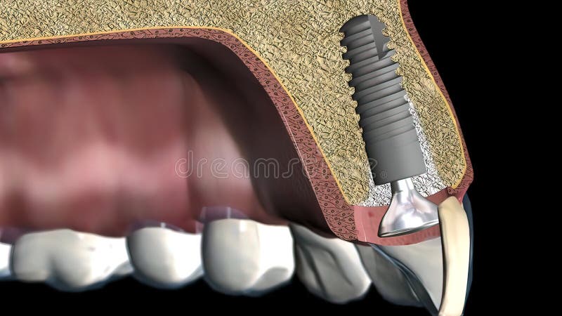 Placement and Alignment of the Implant Stock Illustration ...