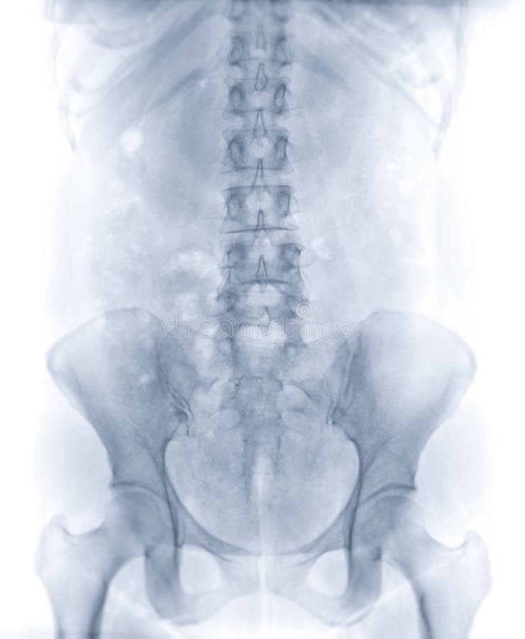 Plain Abdomen or Plain Kub is X-ray Image of Human Abdominal Part Stock ...