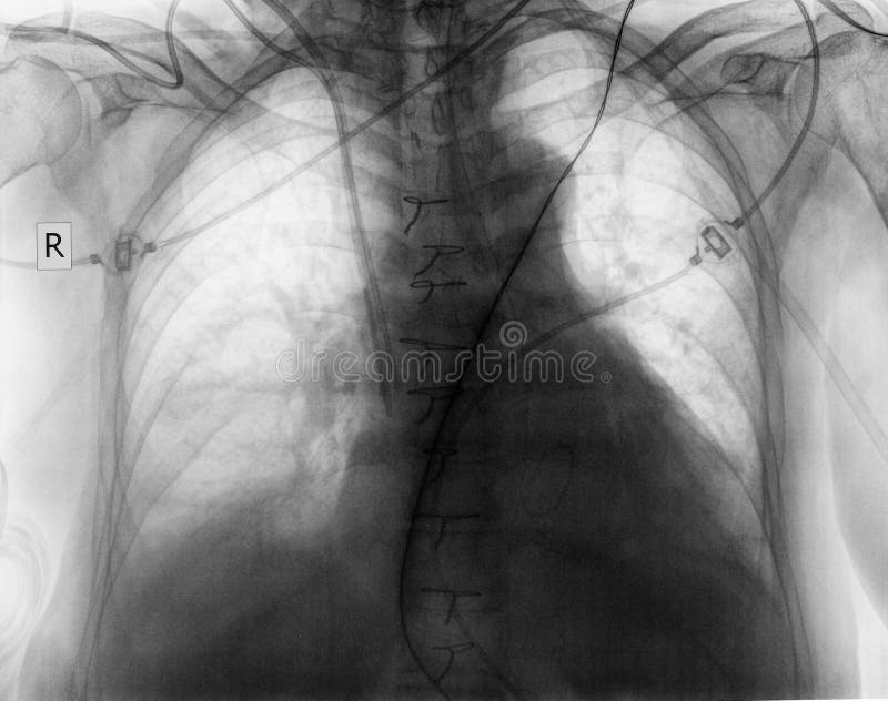 Plain Chest Radiograph of Patient after Surgery Stock Photo - Image of ...