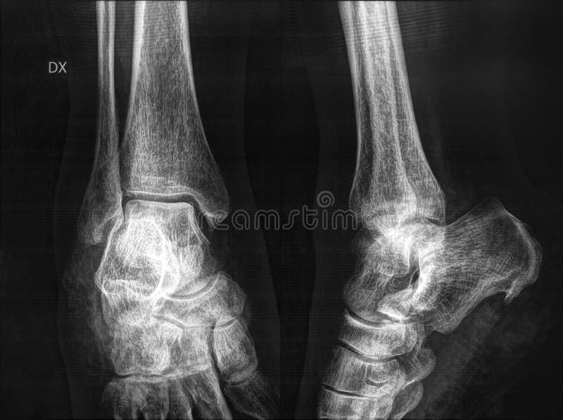 Spur Accident Woman Broken Stock Photos - Free & Royalty-Free Stock ...