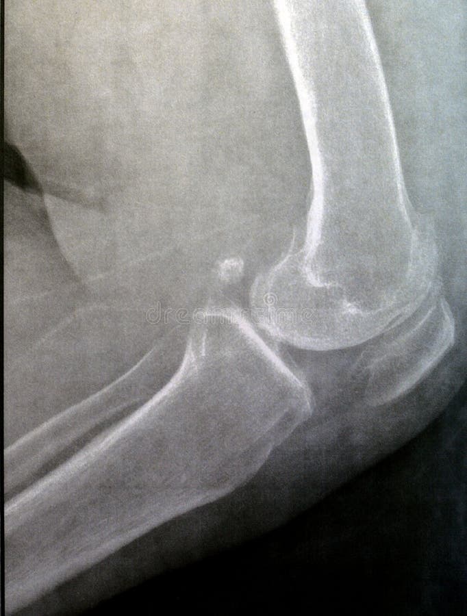 Plain X Ray of the Left Knee Shows Apparent Joint Osteoarthritis ...