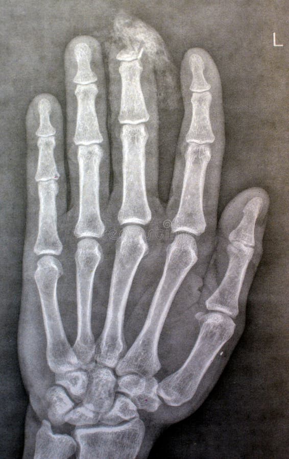 Plain X-Ray Reveals Distal Tip Amputation of Distal Phalanx of the ...