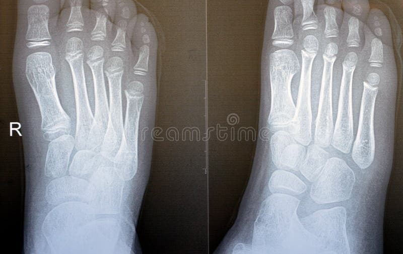 X Ray Foot Normal Xray Image Of Normal Foot Both Side Stock Photo