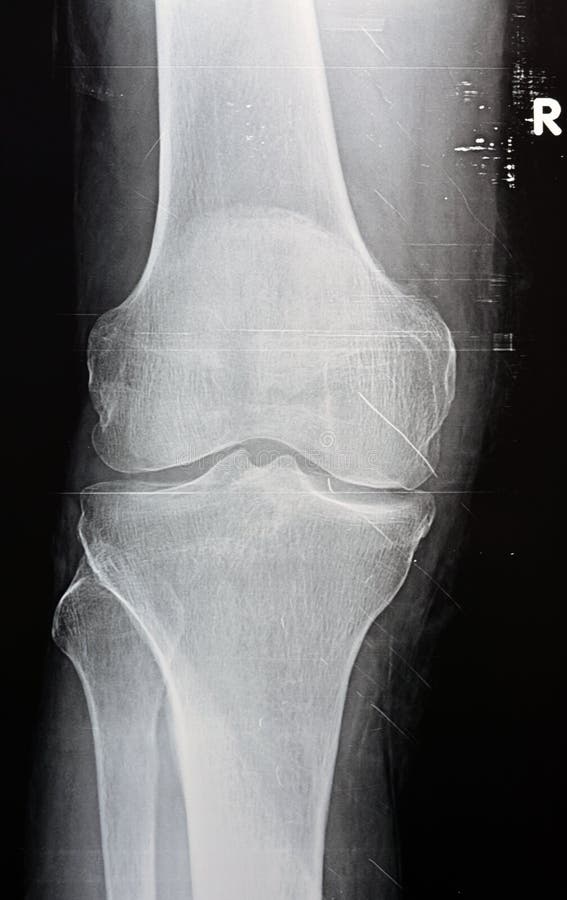 Plain X Ray of the Right Knee Shows Apparent Joint Osteoarthritis ...
