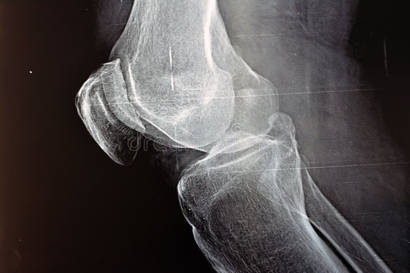 Plain X Ray on Knee Joint Showing Joint Space Narrowing and Subchondral ...
