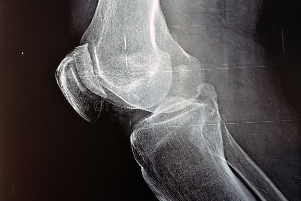 Plain X Ray of the Right Knee Shows Apparent Joint Osteoarthritis ...