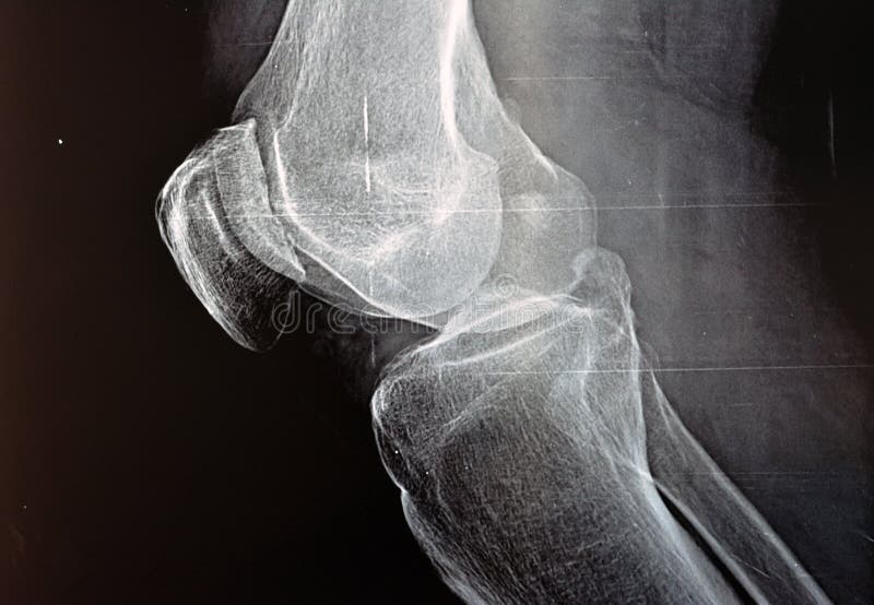 Plain X Ray of the Right Knee Shows Apparent Joint Osteoarthritis ...