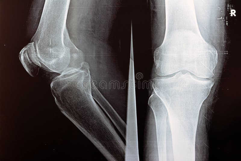 Plain X Ray of the Right Knee Shows Apparent Joint Osteoarthritis ...
