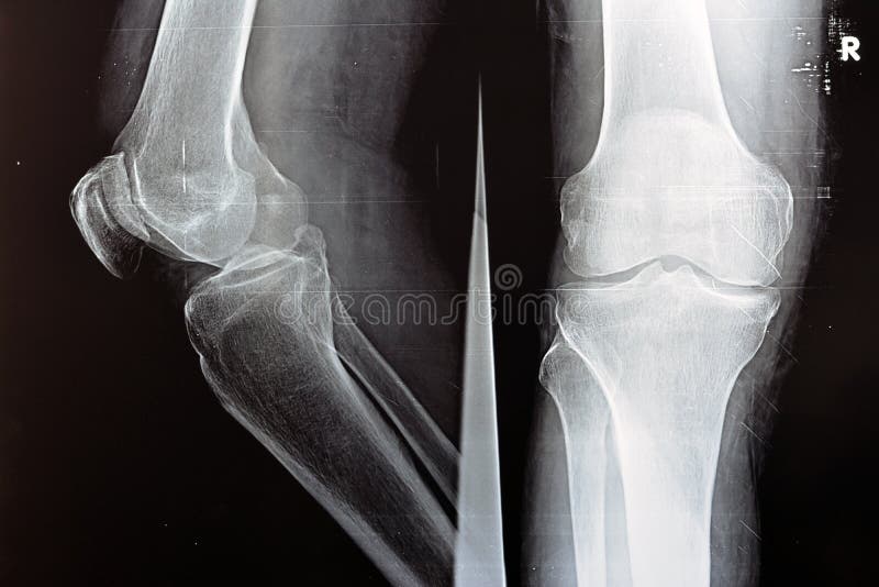 Plain X Ray of the Right Knee Shows Apparent Joint Osteoarthritis ...