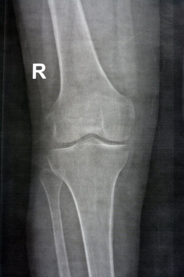 Plain X Ray of the Right Knee Shows Apparent Joint Osteoarthritis ...