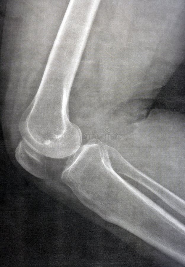 Plain X Ray on Knee Joint Showing Joint Space Narrowing and Subchondral ...