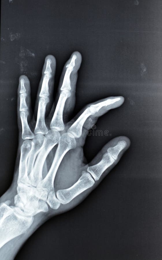 Broken Middle Finger X Ray