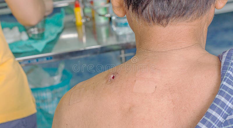 Blessure d'abcès de jambe image stock. Image du rectification - 63785803