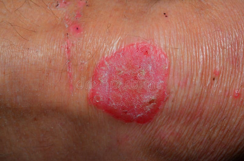Psoriasis image stock. Image of rouge, commun, adulte - 49976911