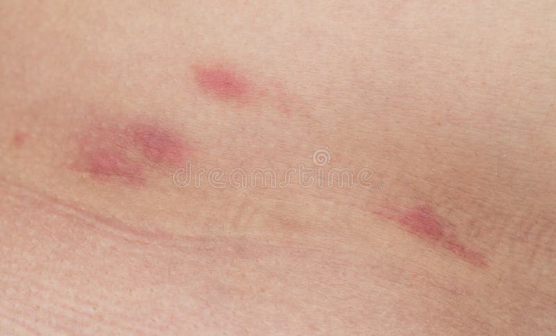 Piqûres De Puce Sur Un Humain Photo stock - Image du canis, cheveu ...