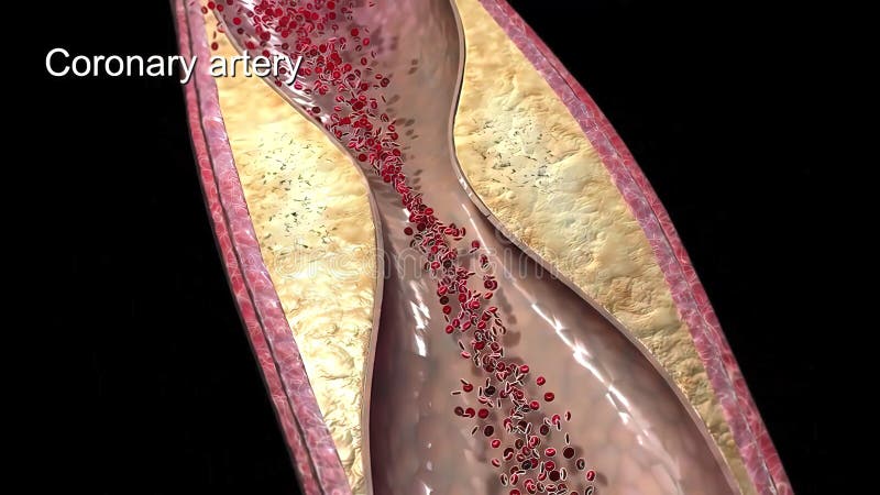 Plaque Formation in the Cardiovascular System Stock Illustration ...