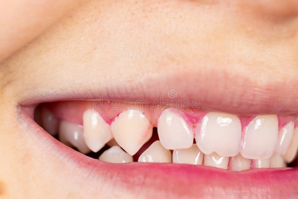 Plaque on Human Teeth is Colored Pink with Indicator Tablets. Stock ...
