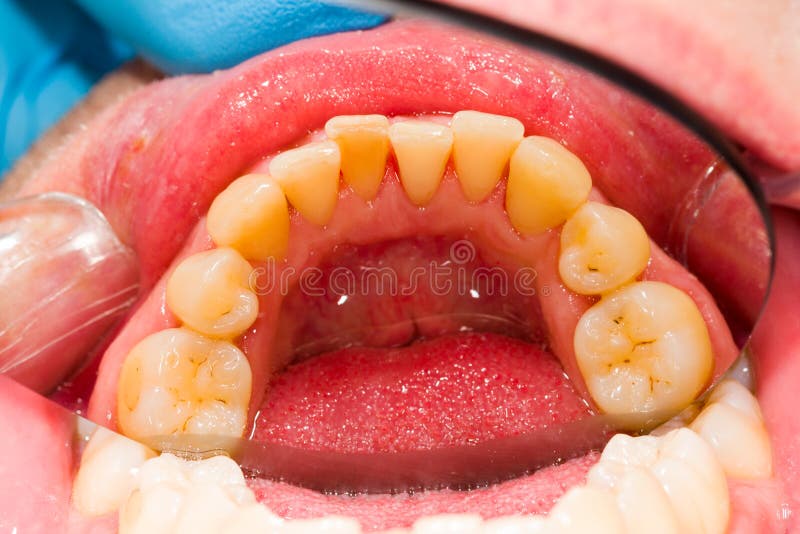 Before Plaque Removal stock photo. Image of healthcare - 37784640