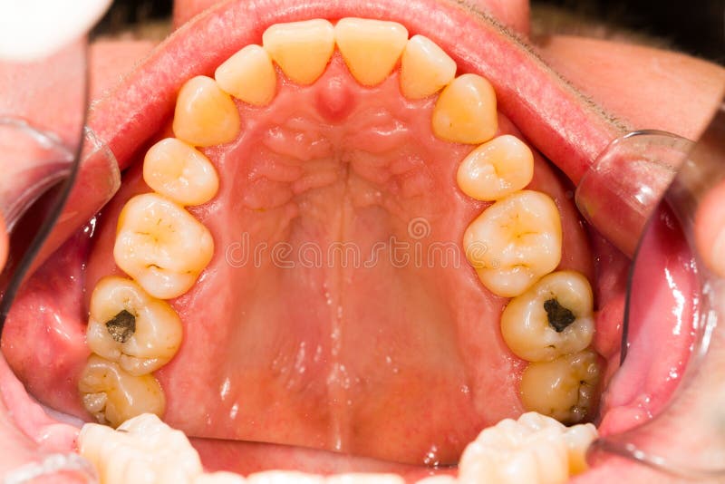 Before Plaque Removal stock photo. Image of healthcare - 37784640