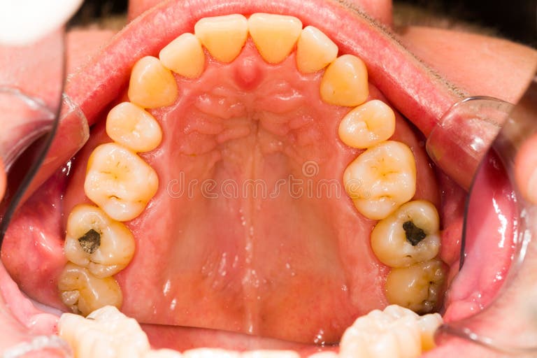 After Plaque Removal stock photo. Image of care, natural - 56022196