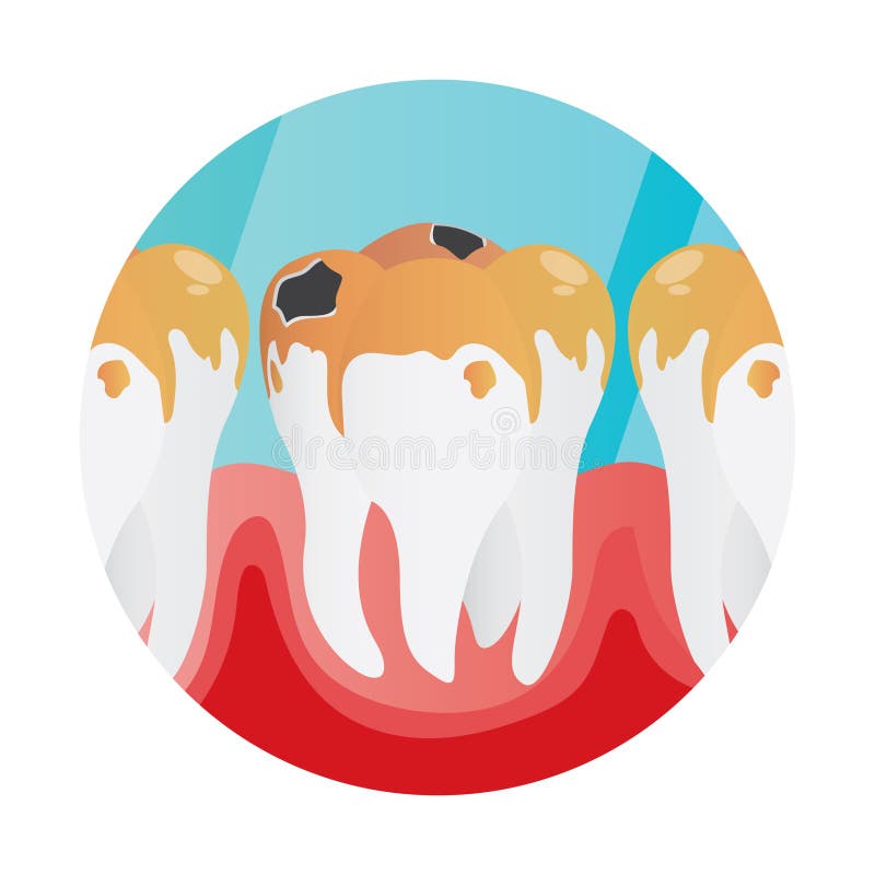 Plaque Teeth Stock Illustrations – 2,067 Plaque Teeth Stock ...