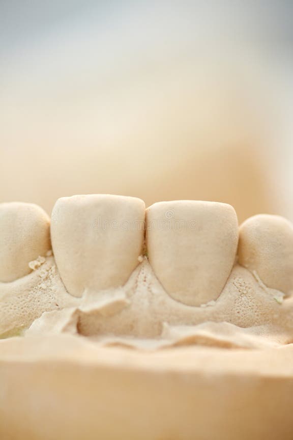 Plaster Cast of Front Teeth Stock Image - Image of fabrication, model ...
