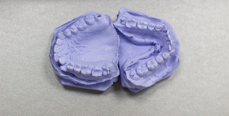Plaster Cast of Teeth from Plaster at the Orthodontist Stock Image ...
