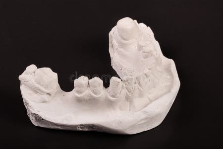 Plaster Cast of Teeth with Removable Partial Denture on a Dark ...
