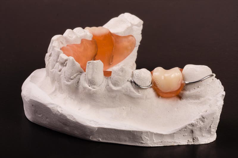 Plaster Cast of Teeth with Removable Partial Denture on a Dark ...