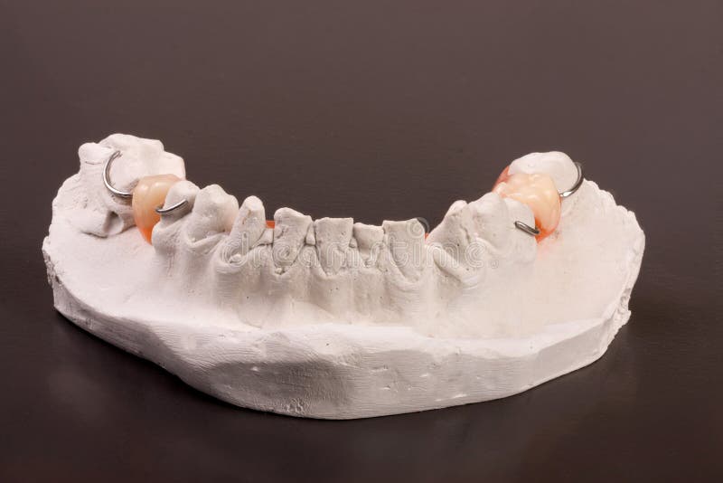 Plaster Cast of Teeth with Removable Partial Denture on a Dark ...