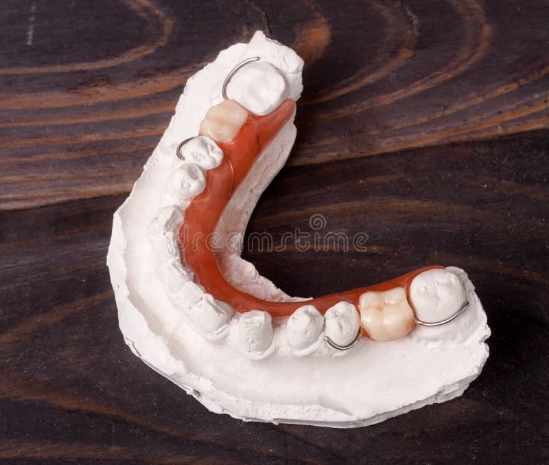 Plaster Cast of Teeth with Removable Partial Denture on a Dark ...